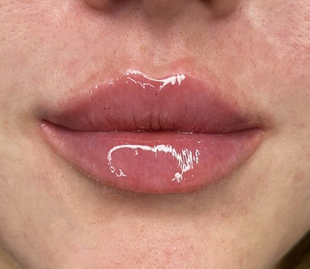 Russian lips - Advanced Aesthetics Clinic & Training School
